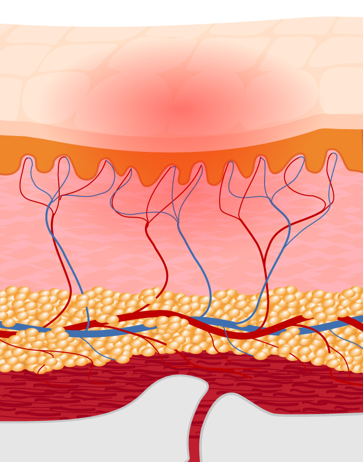 Was ist ein DEKUBITUS? Wie kann er entstehen? - Carenetic